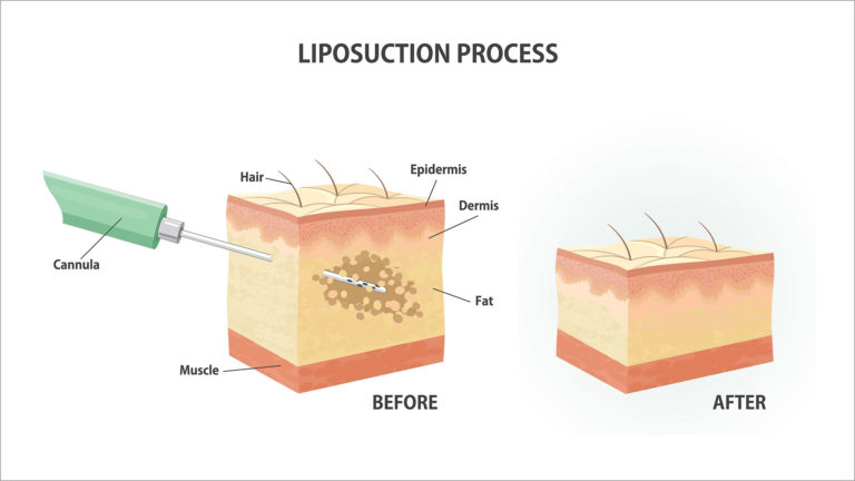 Sono Bello Review 2022 - Rip-Off or Worth To Try? Here is Why..